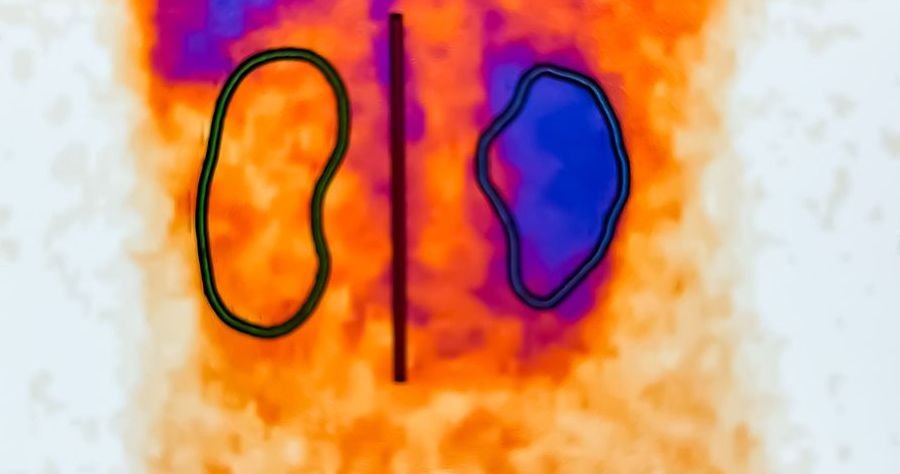 MAG3 renogram | Kidney Care UK